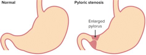 What Are The Signs And Symptoms Of Pediatric Pyloric Stenosis Sppi