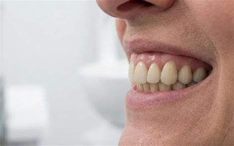 Can Dental Implants Fix Buck Teeth Lema
