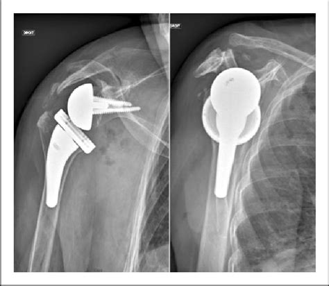 Scapular Spine Fracture Observed At 3 Months Postoperatively