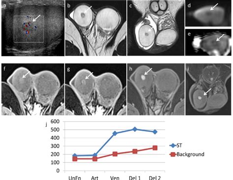 A 45 Year Old Male With Right Testicular Benign Leydig Cell Tumor