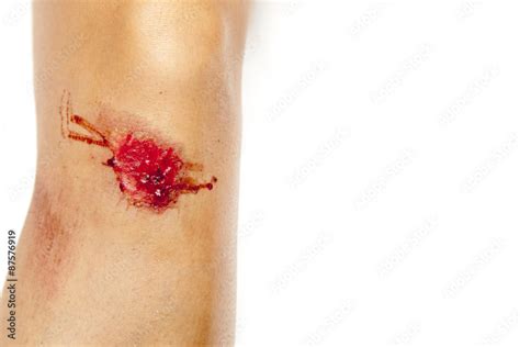 Sport Injury Painful Knee Wound Accident Close Up On An Bleeding