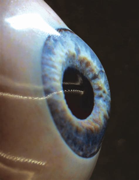 Pdf Three Dimensional Computer Aided Design Of A Full Color Ocular Prosthesis With Textured