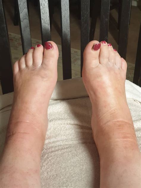 Type 2 Diabetes Leg Swelling