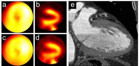Figure 6 From Title Cause Of Apical Thinning On Attenuation Corrected Myocardial Perfusionspect