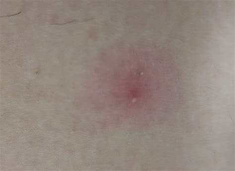 진드기 물린자국 지식in