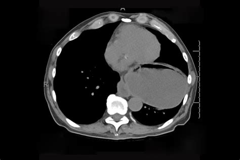 Physicians Resolve Large Hiatal Hernia Nyu Langone Physician Focus