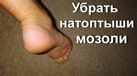 Как лечить натоптыши чем их вылечить на подошве ног стопах пятках