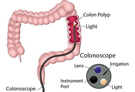Colonoscopy Johns Hopkins Medicine