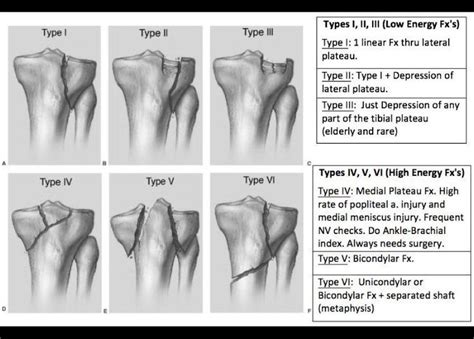 Tibial Plateau Fracture Classification