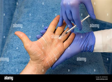 Beautician Makes Intramuscular Injections Of Botulinum Toxin In Palm Against Hyperhidrosis Male