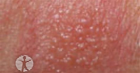 Positive Patch Test Image