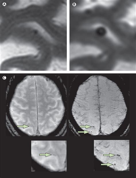 Cerebral Microbleeds A Guide To Detection And Interpretation The Lancet Neurology