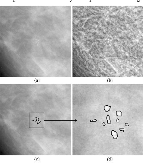 Figure 3 From Breast Cancer Diagnosis Analyzing Texture Of Tissue
