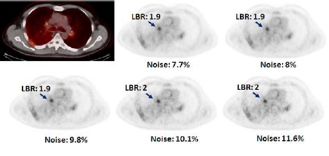 patient images reconstructed with tof algorithm injected dose 377 4