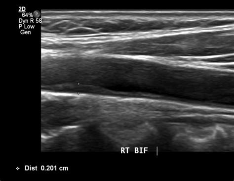 경동맥 초음파 경동맥 협착 내중막 두께 증가와 동맥경화반의 치료 네이버 블로그