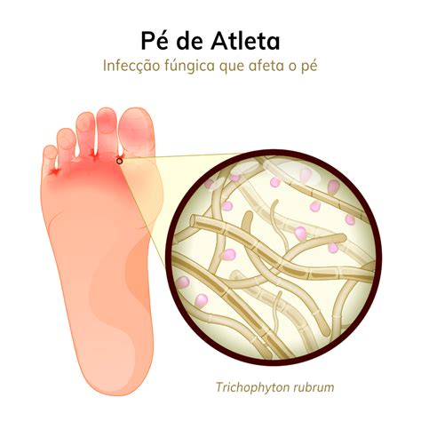 Fotos De Micose No Pé Fdplearn