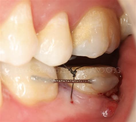 Intentional Replantation In Distal Root Defect Made By Wisdom Tooth Style Italiano Endodontics