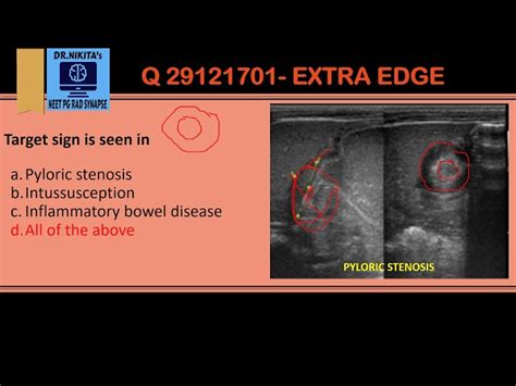 Target Sign Intussusception