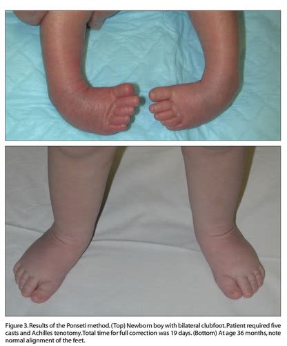 Metatarsus Adductus Vs Clubfoot