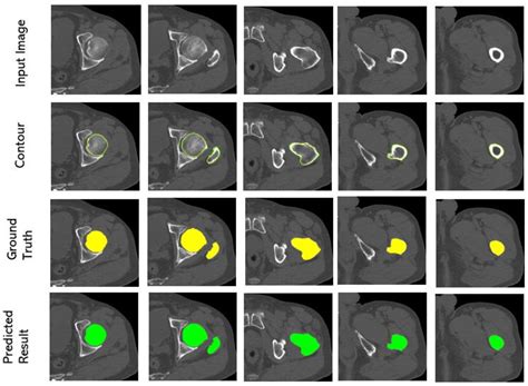 Figure 2 From A Deep Learning Based Approach To Extracting Periosteal And Endosteal Contours Of