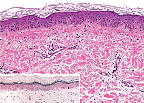 Vitiligo And Other Disorders Of Hypopigmentation Clinical Tree