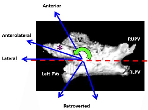 Three Dimensional Surface Rendered Image Of The Left Atrium Viewed From Download Scientific
