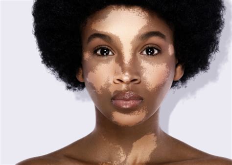 Vitiligo Causes And Treatments Dermatology Inc