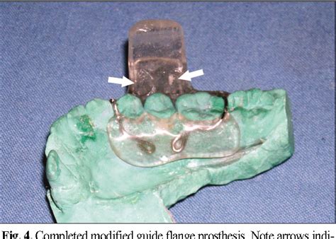 Hemimandibulectomy Semantic Scholar