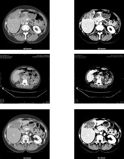 Automated Liver Tumor Detectionreadmemd At Main · Di Baautomated