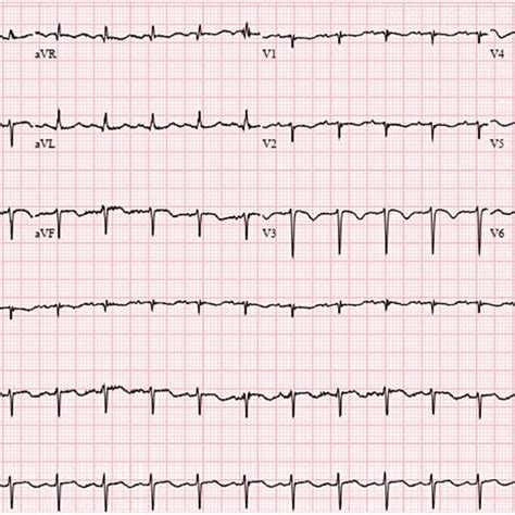 Electrocardiogram ECG On Admission Showing Left Axis Deviation Sinus Download Scientific