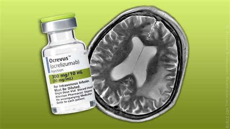 Pml Reported In Ocrelizumab Treated Ms Patient Medpage Today