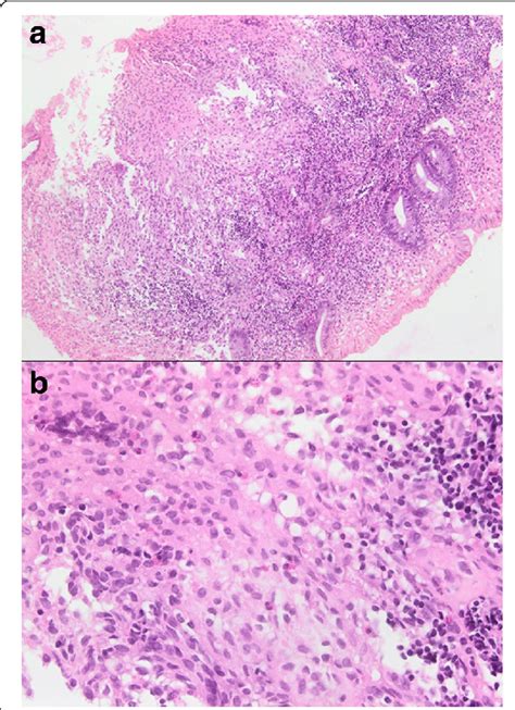 Biopsy From The Sigmoid Colon A Colonic Biopsy Showing Histiocytoid Download Scientific
