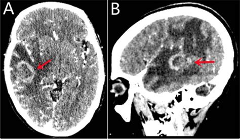 Brain Mri Showed An Irregular Mass In The Right Temporal Lobe With Download Scientific Diagram