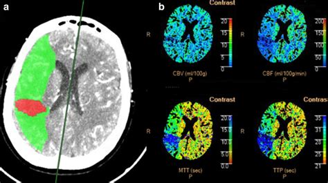 “code Stroke” Ct Perfusion Challenges And Pitfalls Academic Radiology
