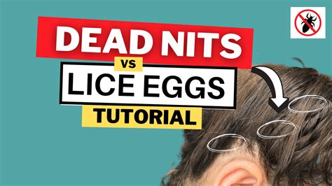 Dead Nits Vs Live Lice Eggs Video Tutorial My Lice Advice
