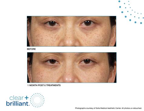 California Coastal Dermatology Clear Brilliant