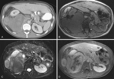 Retroperitoneum Clinical Tree