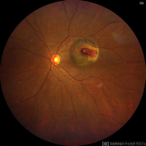 Ruptured Macroaneurysm Retina Image Bank