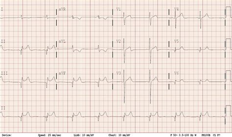 Learn How To Classify Ecg Signals With Dl In Knime Knime