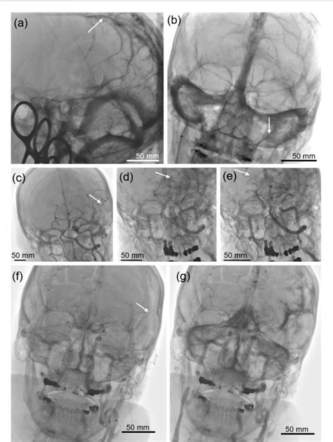 Figure 1 From New Frontiers In Intracranial Imaging With Hf Oct Ex Vivo Human