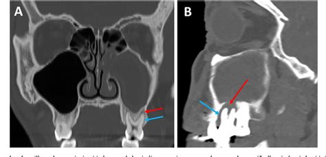 Table 1 From Diagnosing Odontogenic Sinusitis Of Endodontic Origin A Multidisciplinary