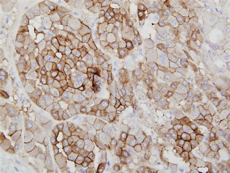 Pathology Outlines Hybrid Oncocytic Chromophobe Tumor