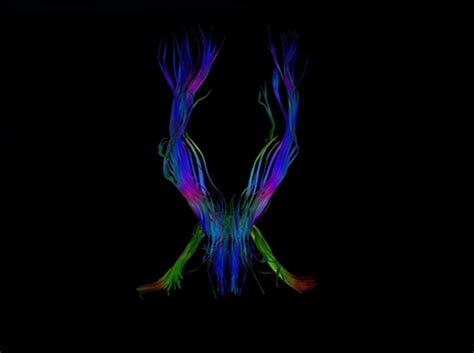 Diffusion Tensor Imaging Tractography Of Patient Showing That Most Download Scientific