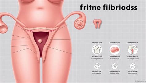 Norethindrone And Fibroid Reduction Insights And Tips