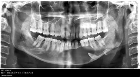 Pdf Adenomatoid Odontogenic Cyst Of Mandible A Rare Case Report Sexiz Pix