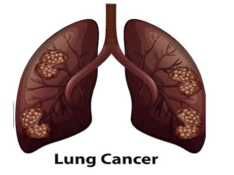 Is Lung Cancer Prevalent In Older Adults 4 Prevention Tips