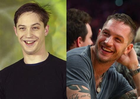 Tom Hardy New Teeth Now Hollywood Smile Before After Lema