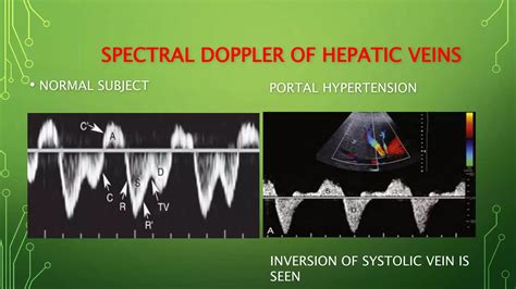Imaging In Portal Hypertension Pptx