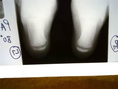 Traction Apophysitis Andrew Clarke Podiatrist