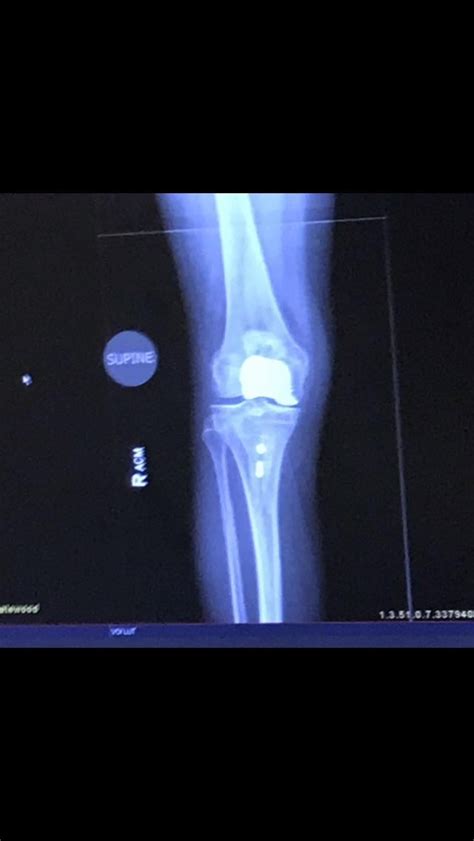 My Uni Knee Replacement R Surgery